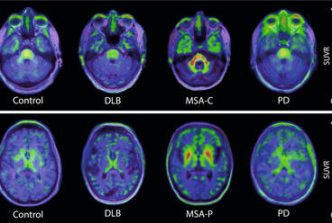Research News | Parkinson's Disease