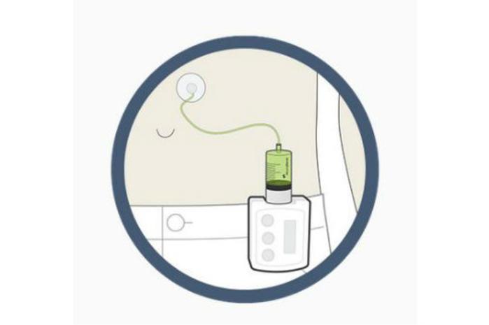 Levodopa Pump Shows Promising Phase II Results | Parkinson's Disease