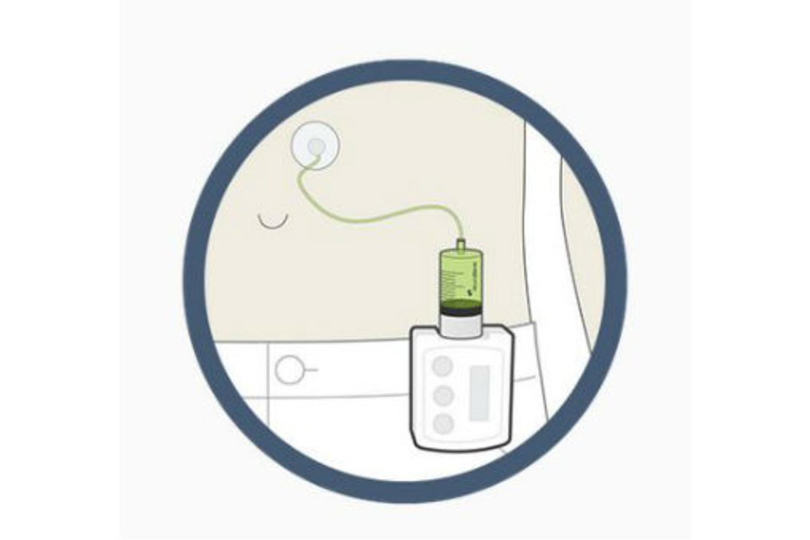 Levodopa Pump Shows Promising Phase II Results | Parkinson's Disease