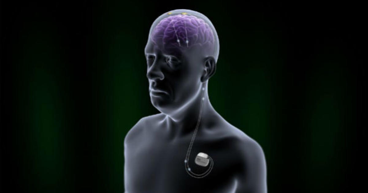 FDA Approves New Deep Brain Stimulation Device | Parkinson's Disease